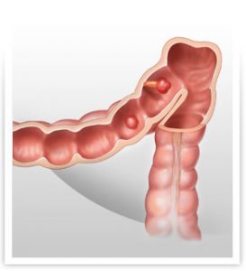 Dr Cesareo | Pólipos